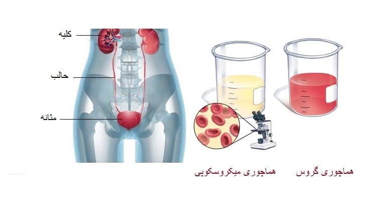 چه زمانی هماچوری گروس خطرناک است؟ دکتر شهریار ناطق جراح کلیه و متخصص